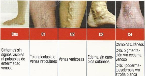 Las varices, esa pesadez en las piernas | Hoy